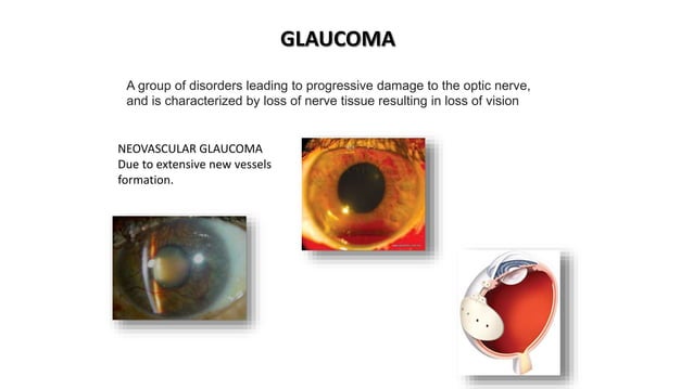 Dm cataract glaucoma | PPTX