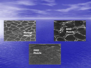 Muscular dystrophy clinical and physiotherapy | PPT