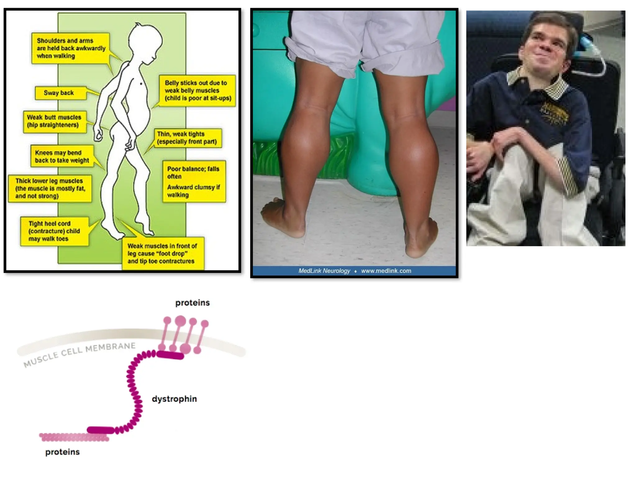 DUCHENNE MUSCULAR DYSTROPHY PRESENTATION | PPTX