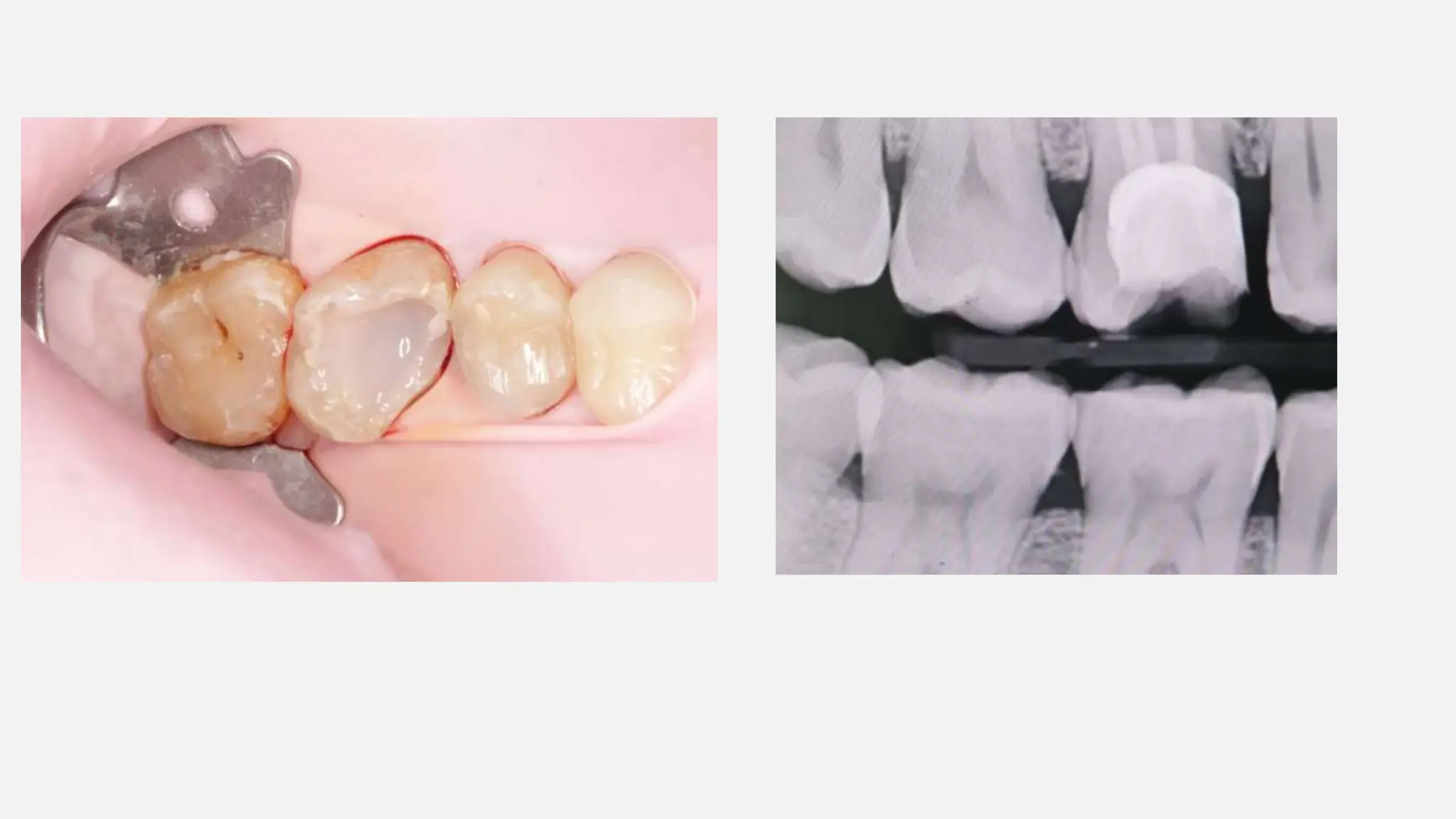 DME deep margin elevation brief ppt.pptx