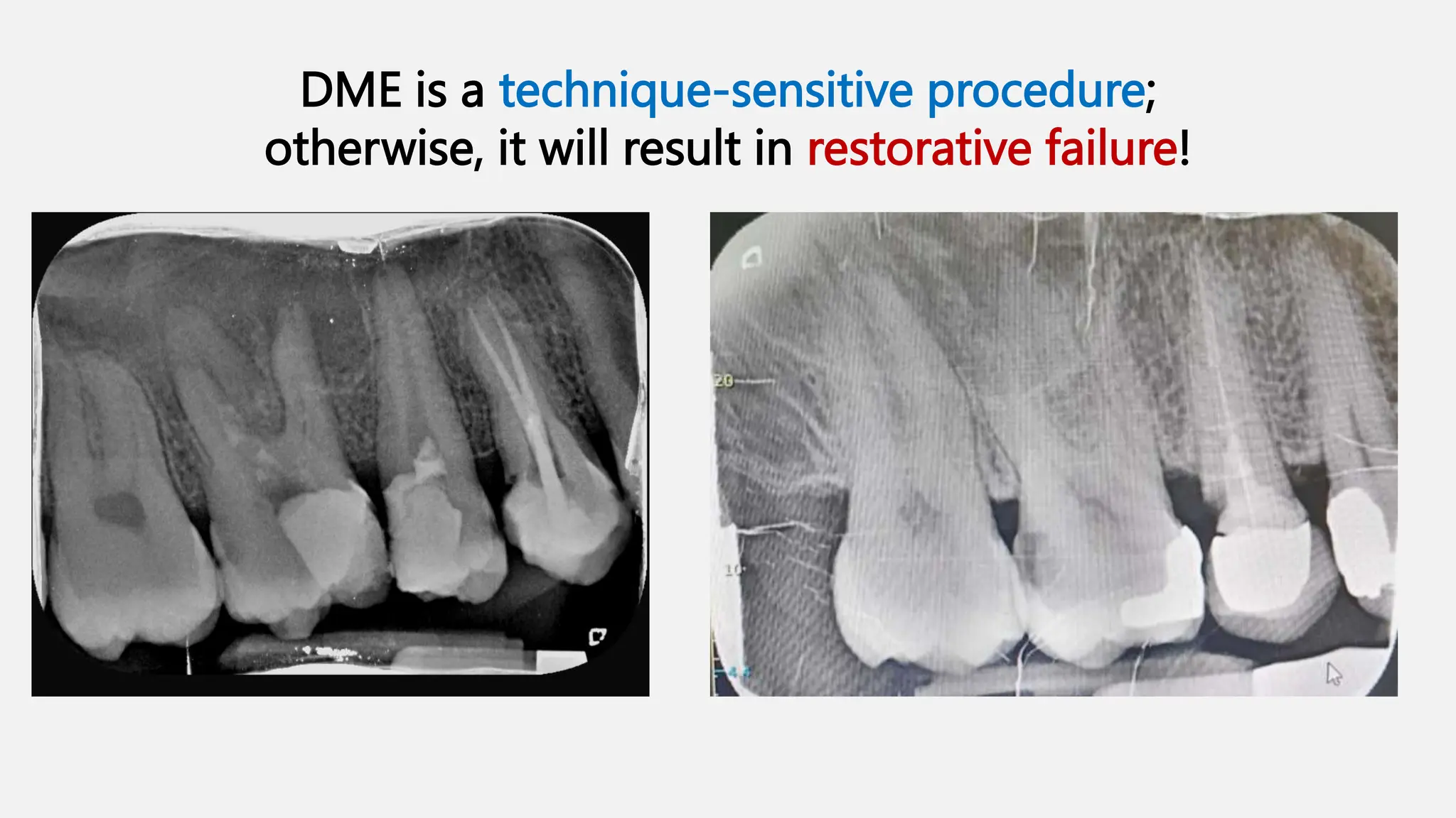 DME deep margin elevation brief ppt.pptx