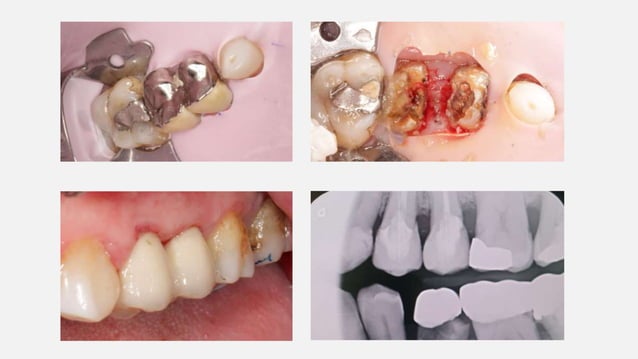 DME deep margin elevation brief ppt.pptx | Oral care | Personal Care