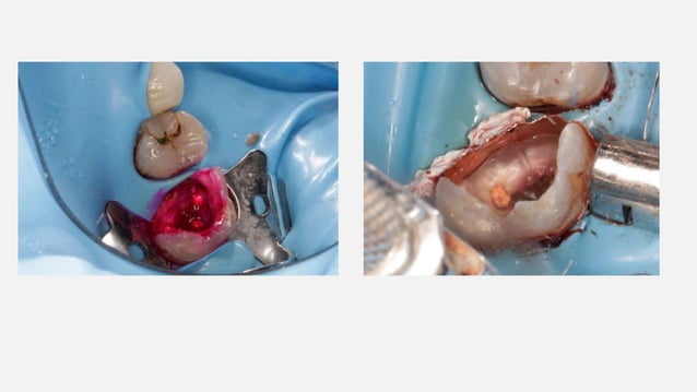 DME deep margin elevation brief ppt.pptx | Oral care | Personal Care