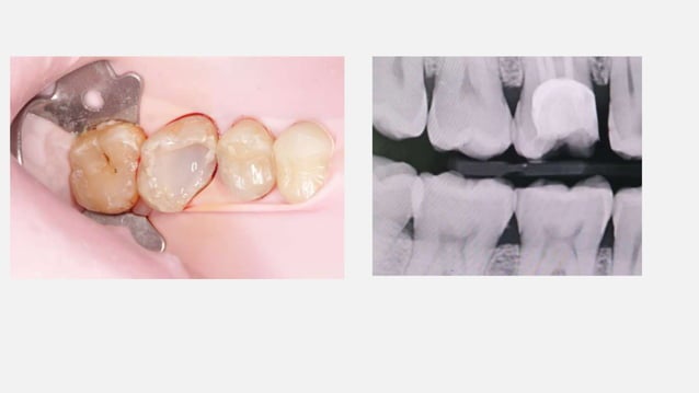 DME deep margin elevation brief ppt.pptx | Oral care | Personal Care