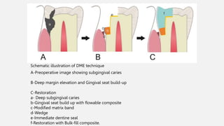 DME deep margin elevation brief ppt.pptx