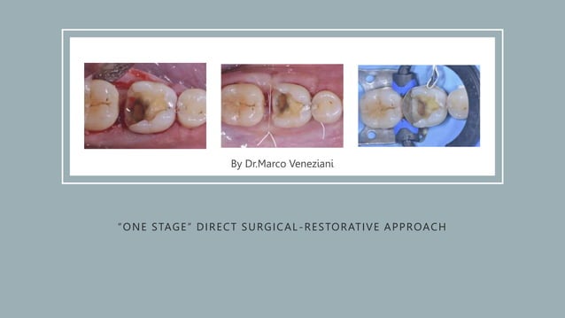 DME deep margin elevation brief ppt.pptx | Oral care | Personal Care