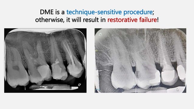 DME deep margin elevation brief ppt.pptx | Oral care | Personal Care