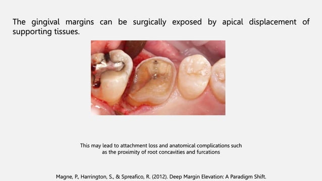 DME deep margin elevation brief ppt.pptx | Oral care | Personal Care