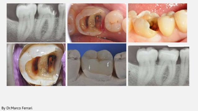DME deep margin elevation brief ppt.pptx | Oral care | Personal Care