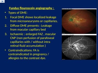 DIABETIC MACULAR EDEMA . RETINA . DIAGNOSIS . MANAGEMENT | PPTX