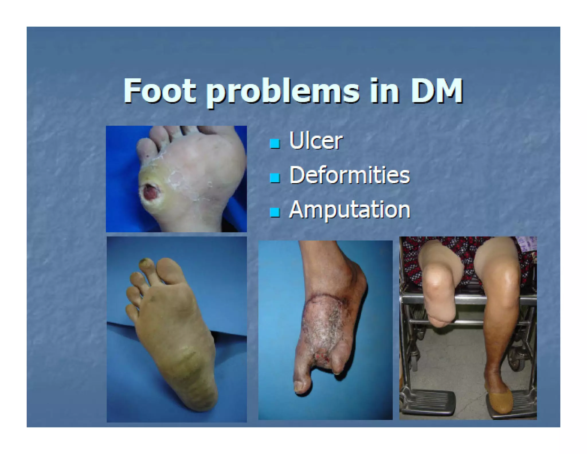 Dm foot | PDF
