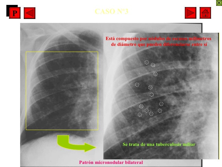 Tac Torax Patron Nodular