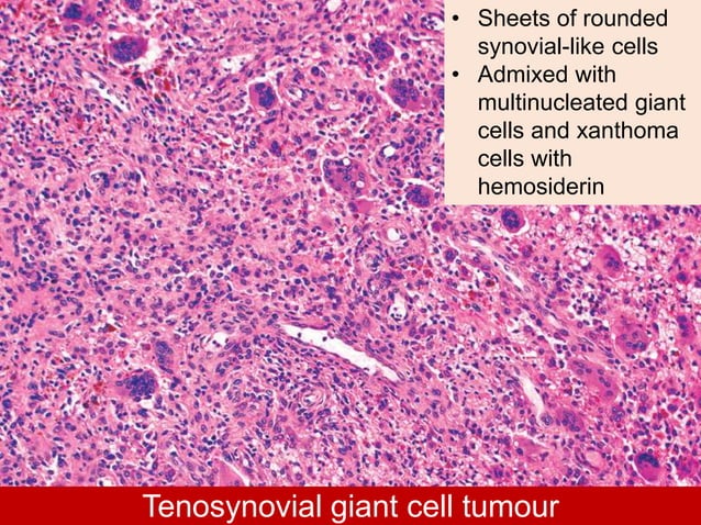 Update on soft tissue tumors | PPTX | Endocrine and Metabolic Diseases ...