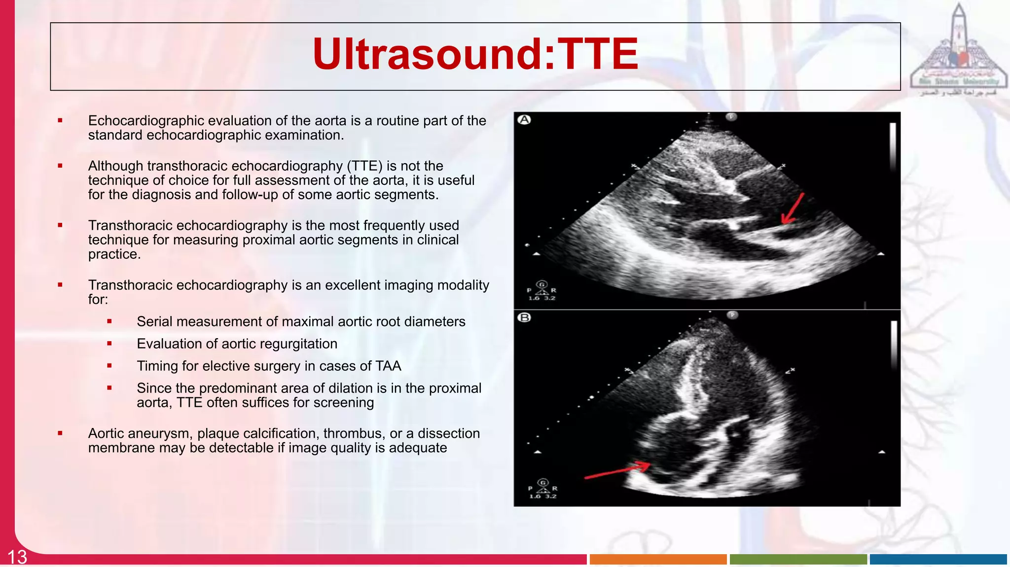 Aortic Diseases Ain Shams Post graduate CTS Course | PPT