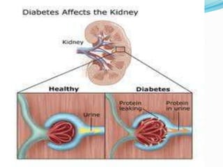 Dm nephro pathy | PPTX