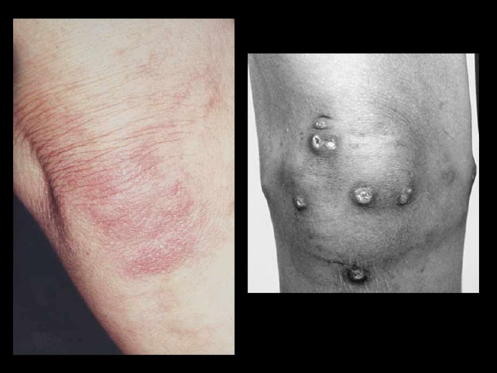 O Que é Dermatomiosite - RETOEDU