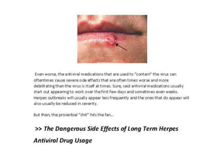 Dmso Herpes | PPTX