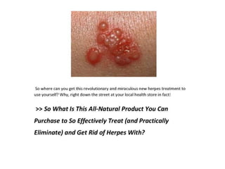 Dmso Herpes | PPTX