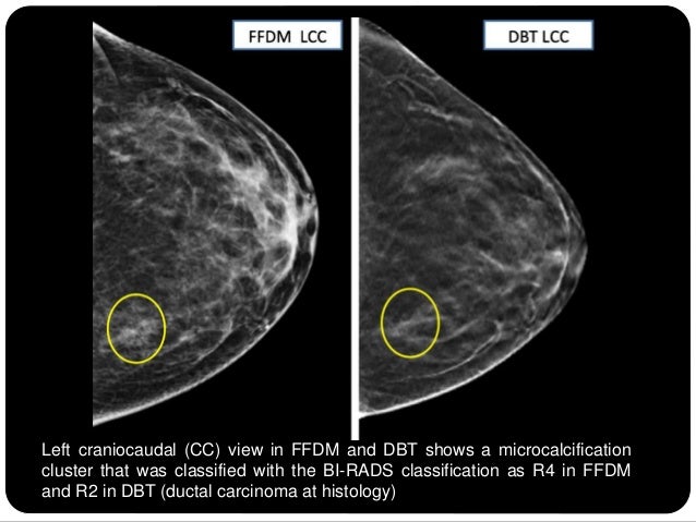 Digital Breast Tomosynthesis, Microcalcifications