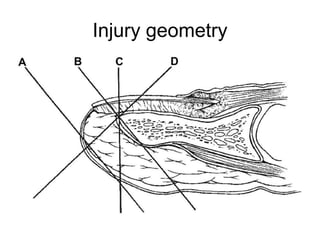 Fingertip injuries surgical management 1 | PPTX