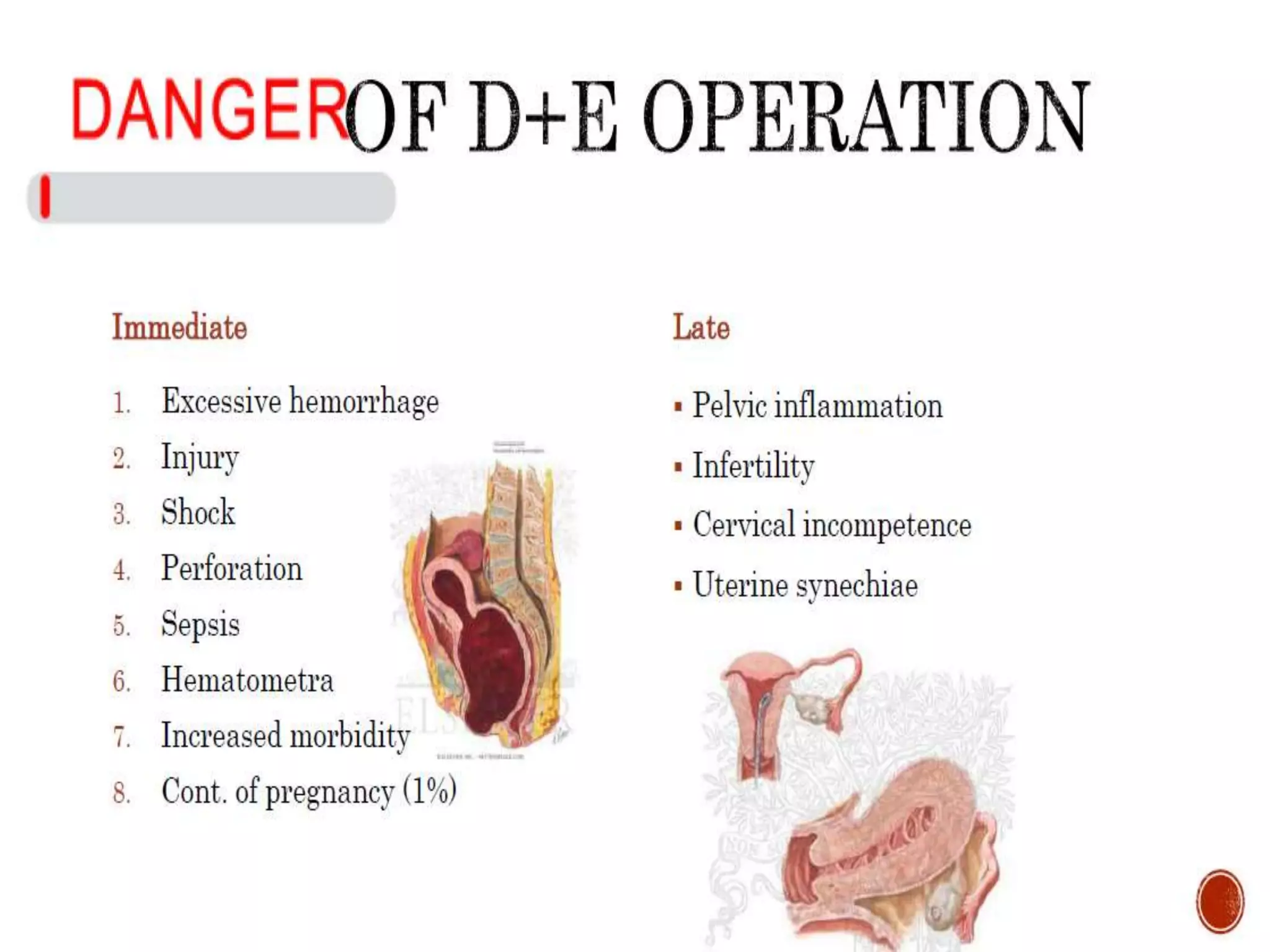 D&E procedure | PPTX