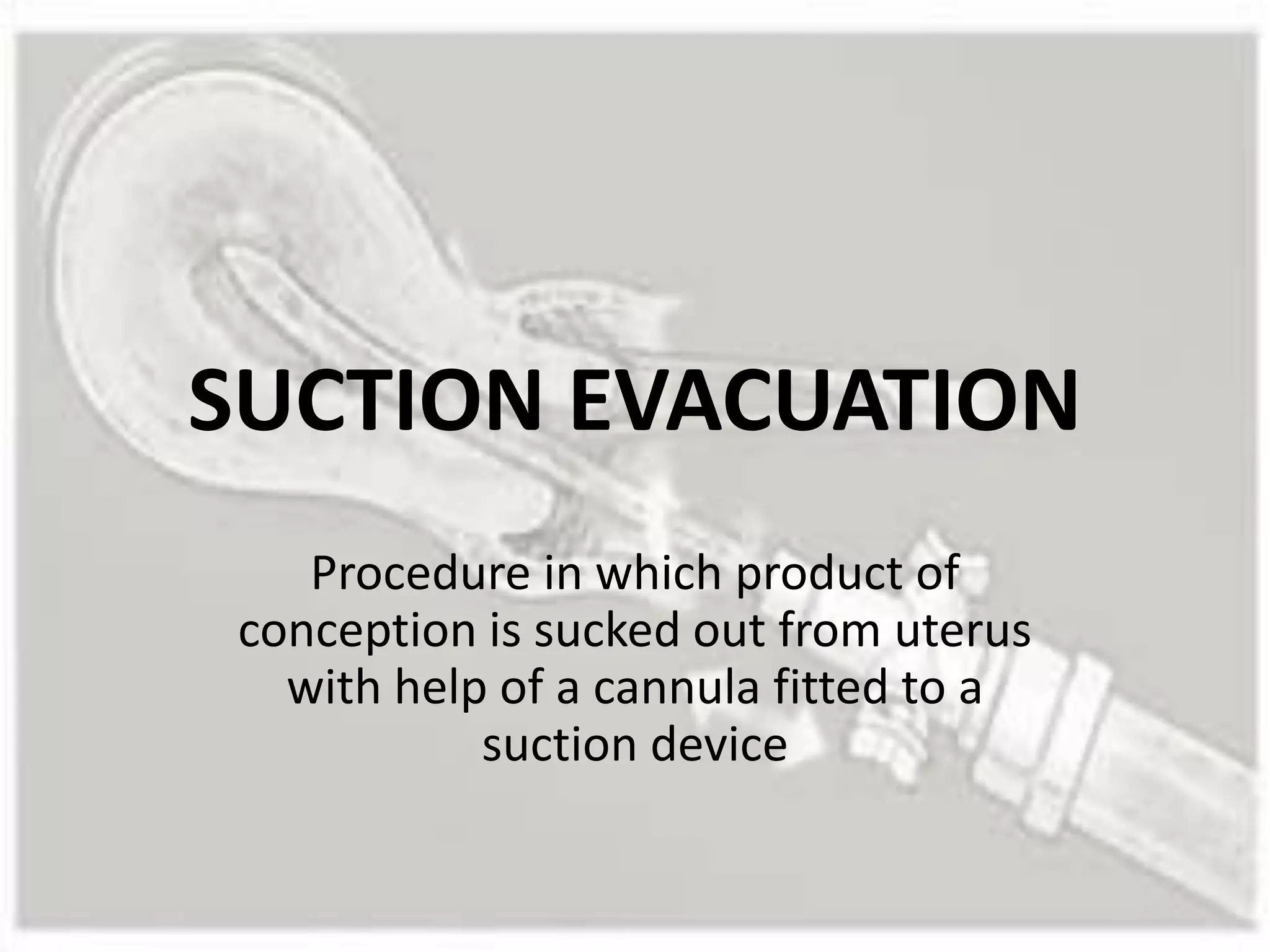 D&E procedure | PPTX