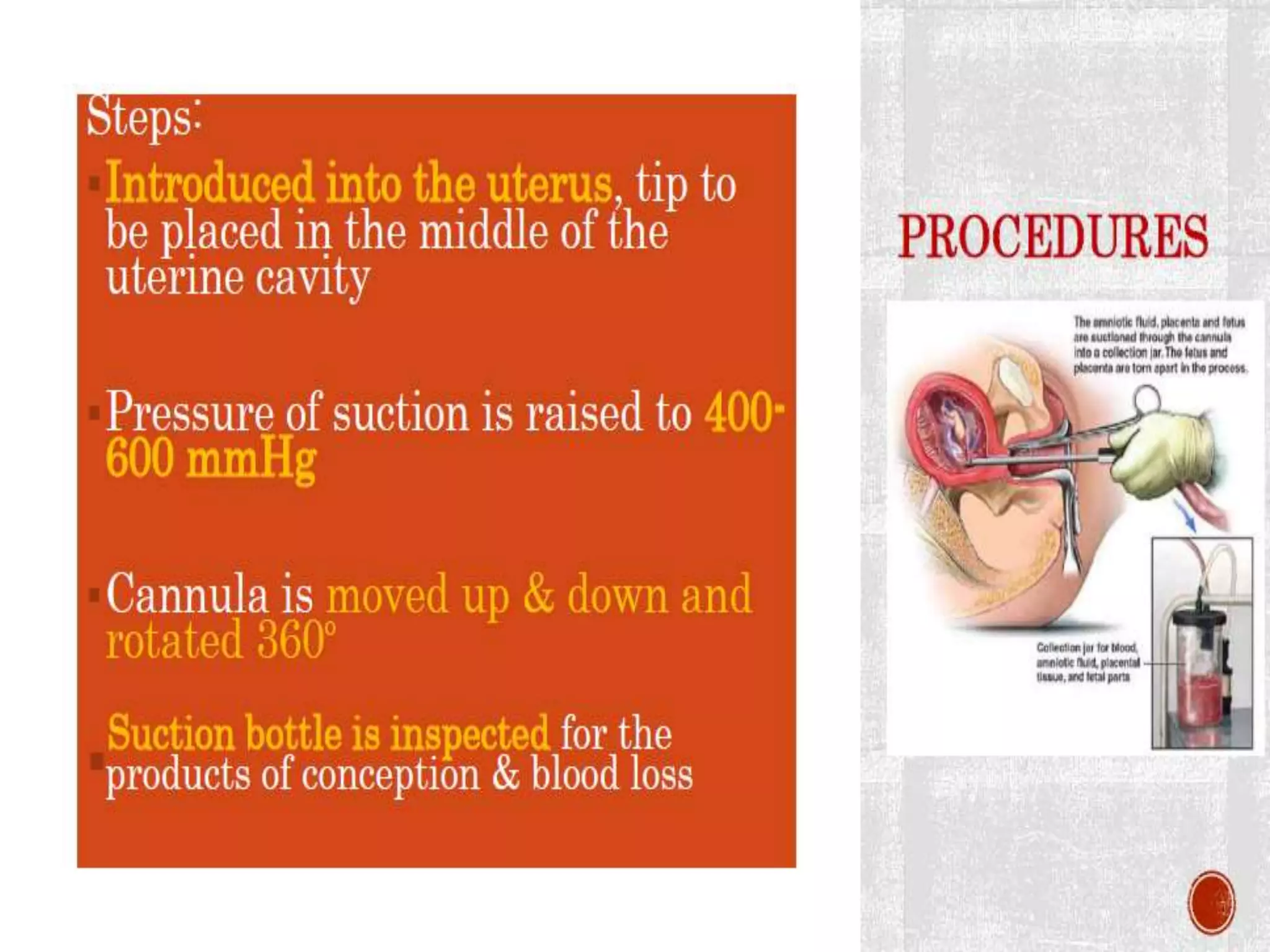 D&E procedure | PPTX