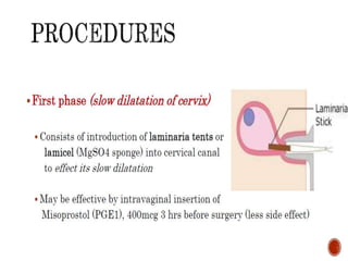 D&E procedure | PPTX