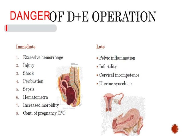 D&E procedure | PPTX