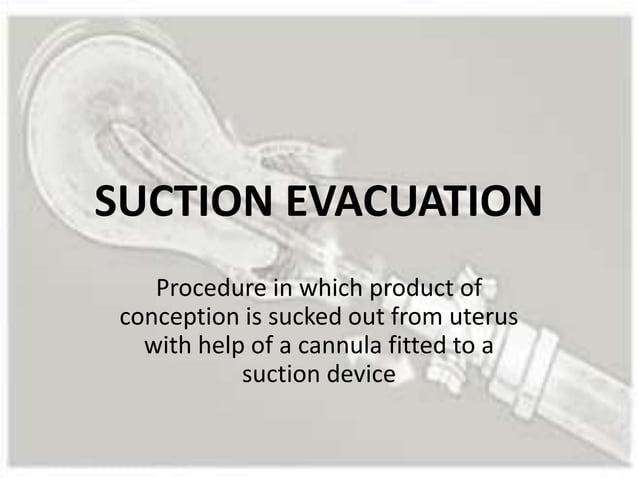 D&E procedure | PPTX