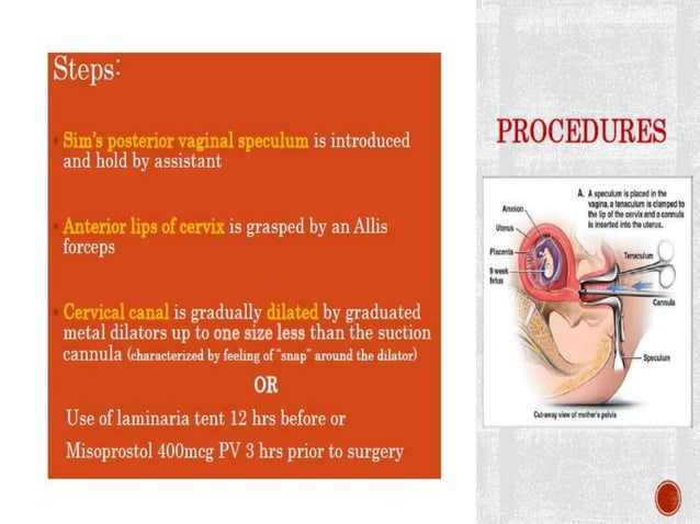 D&E procedure | PPTX