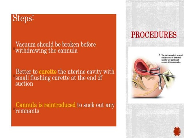 D&E procedure | PPTX