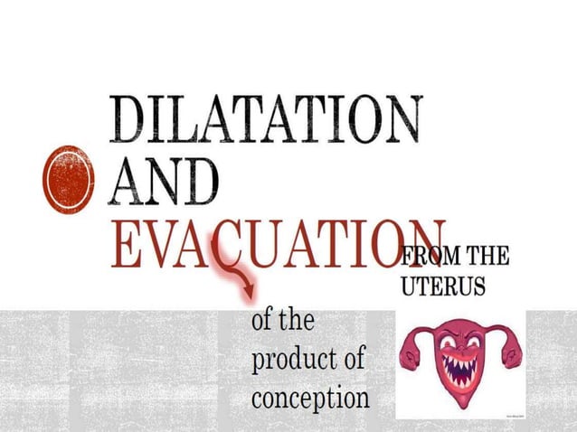D&E procedure | PPTX