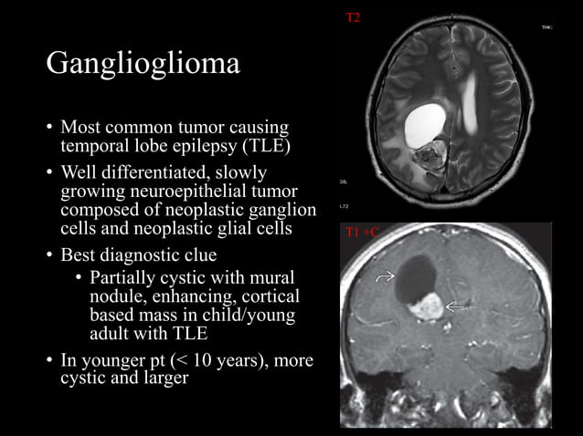 Dysembryoplastic neuroepithelial tumor | PDF | Brain and Nervous System ...