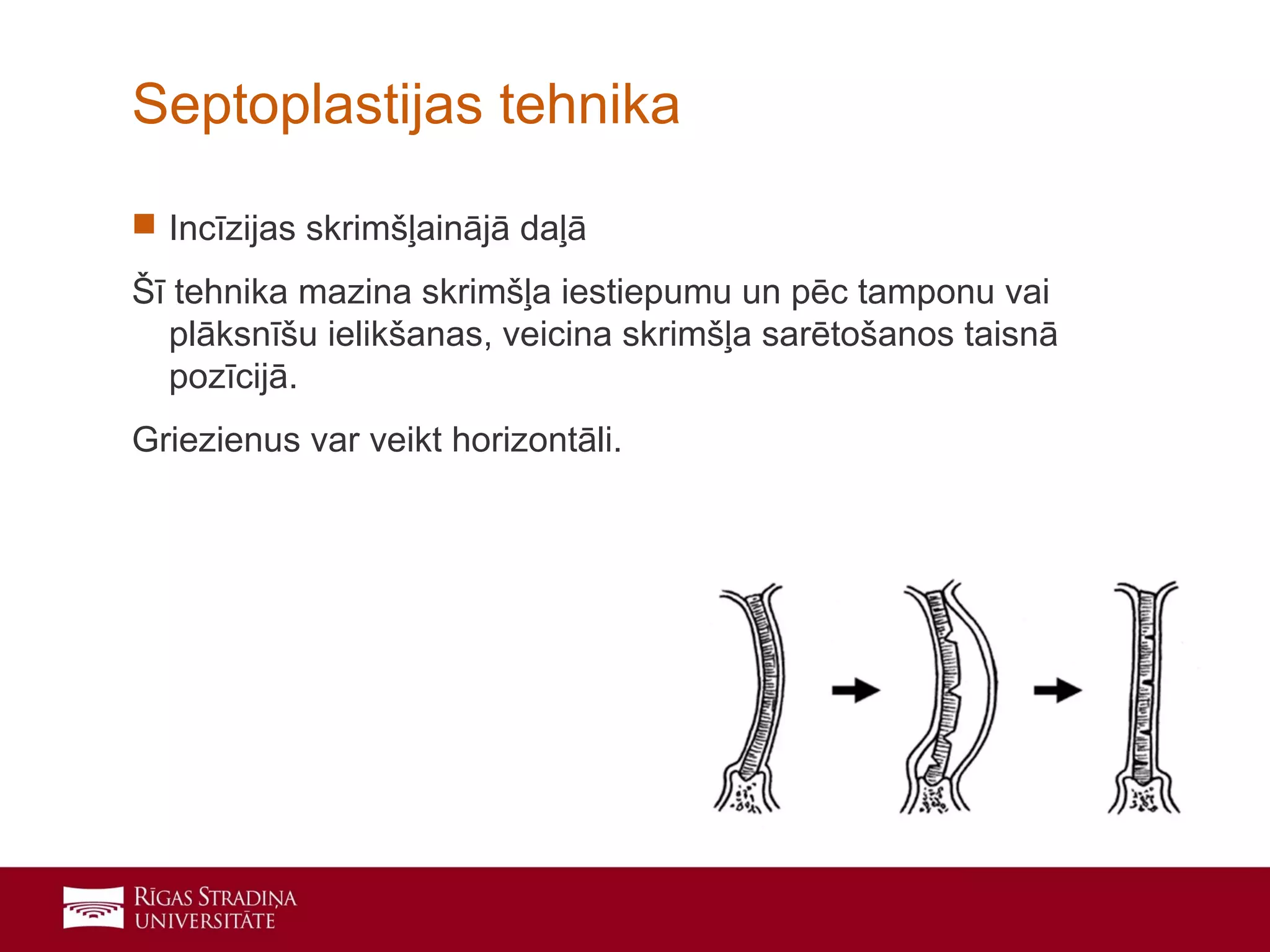 Deguna starpsienas deviācija | PPT