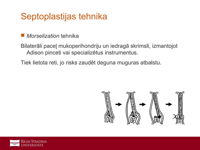 Deguna starpsienas deviācija | PPT