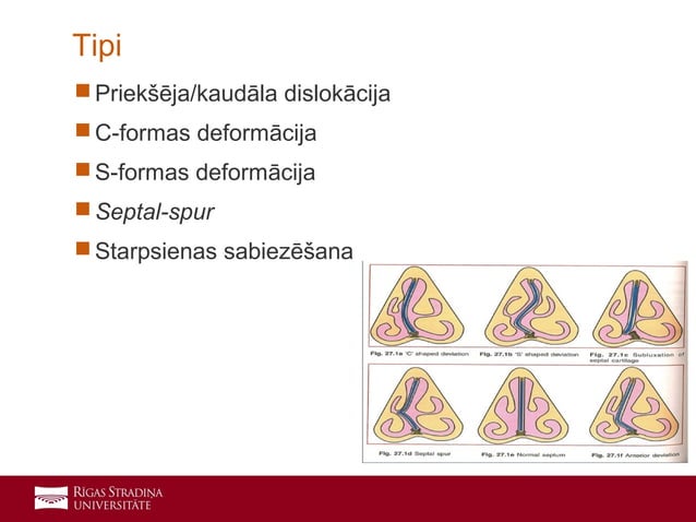Deguna starpsienas deviācija | PPT