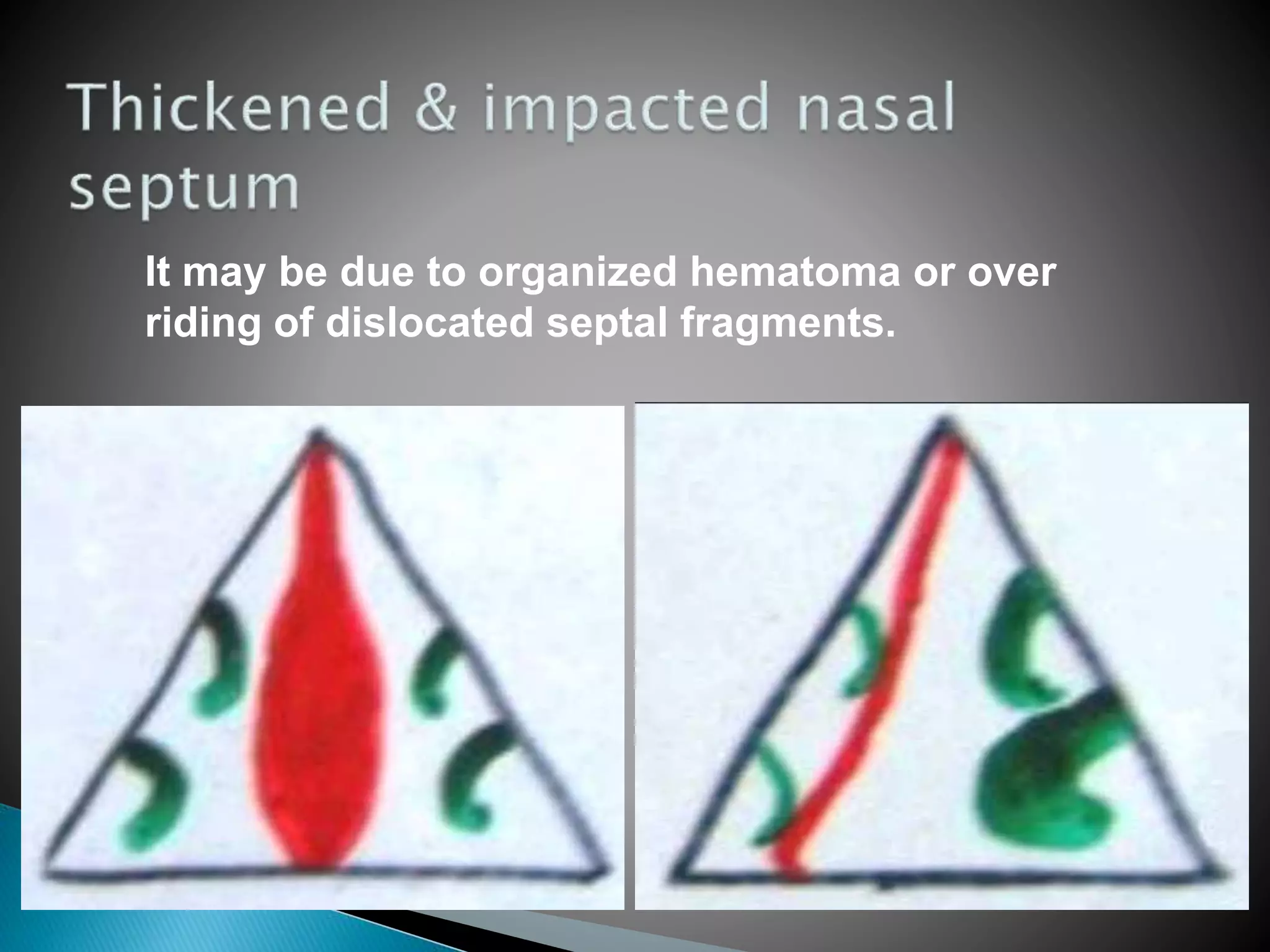 Deviated nasal septum | PPTX