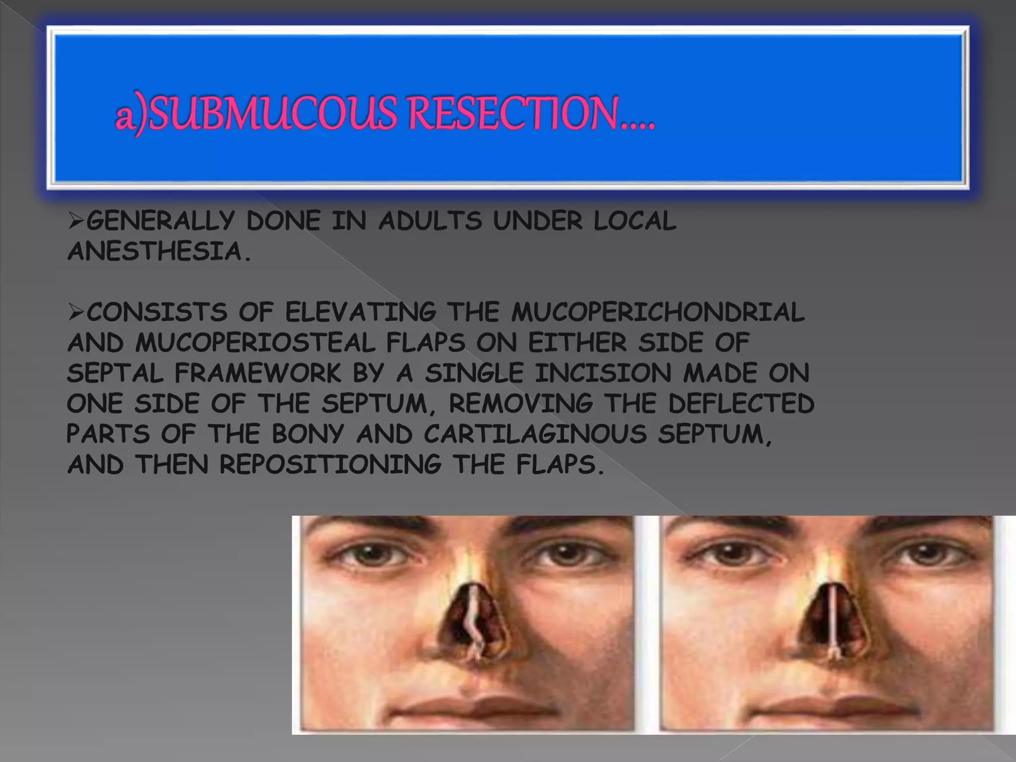 Deviated nasal septum | PPTX