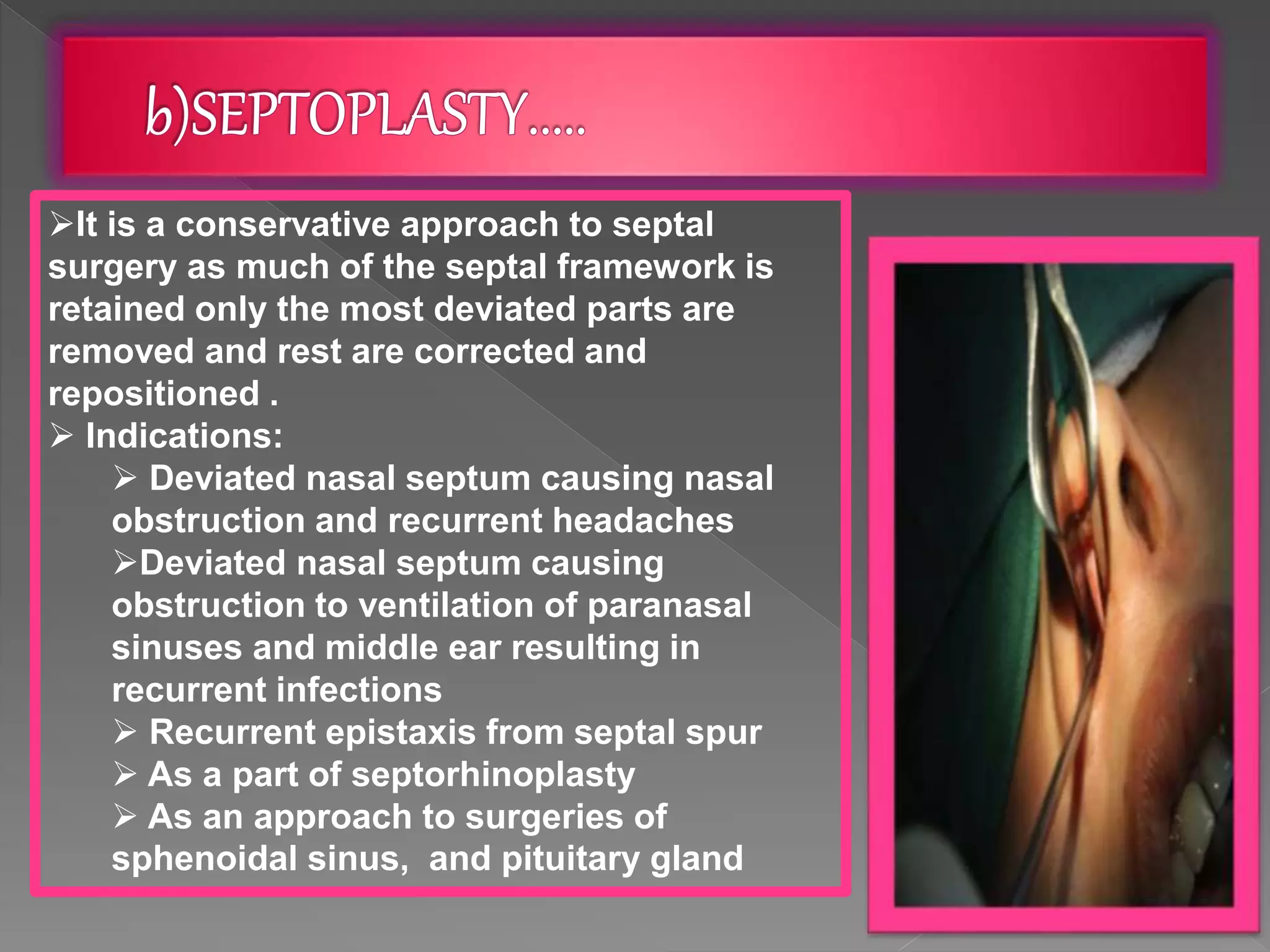 Deviated nasal septum | PPTX