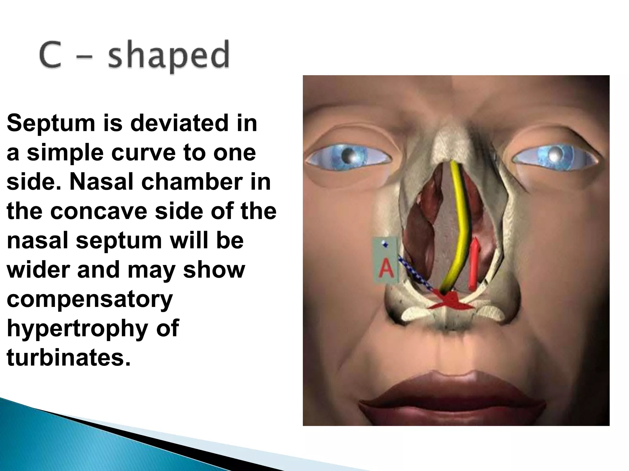 Deviated nasal septum | PPTX