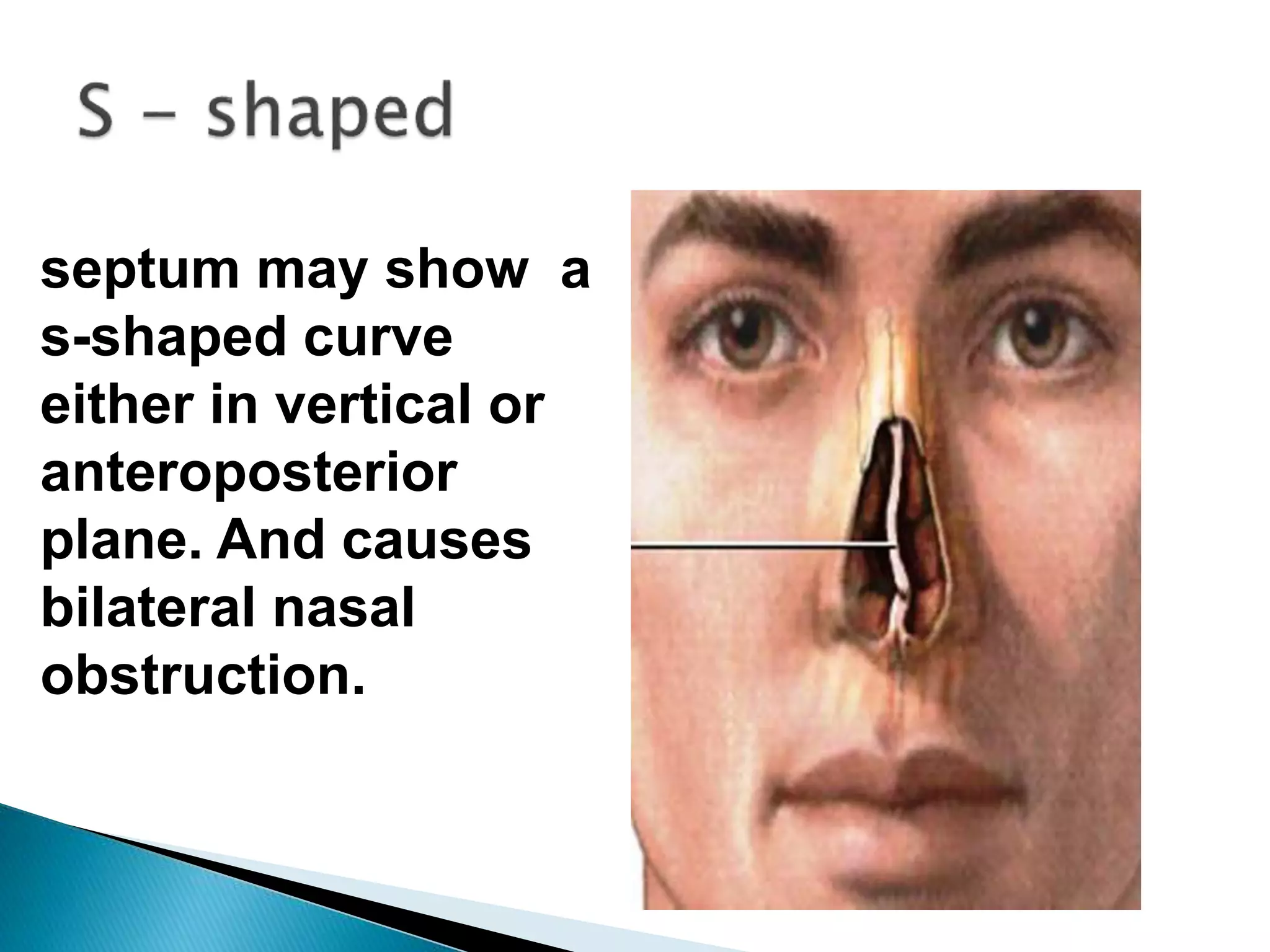 Deviated nasal septum | PPTX