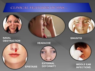 Deviated nasal septum | PPTX