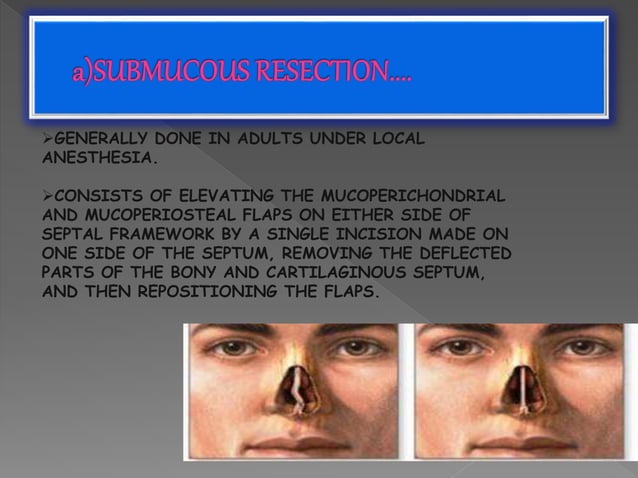 Deviated nasal septum | PPTX