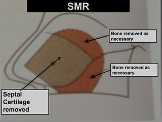 Deviated nasal septum | PPTX