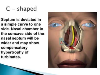 Nasal Septum Deviation