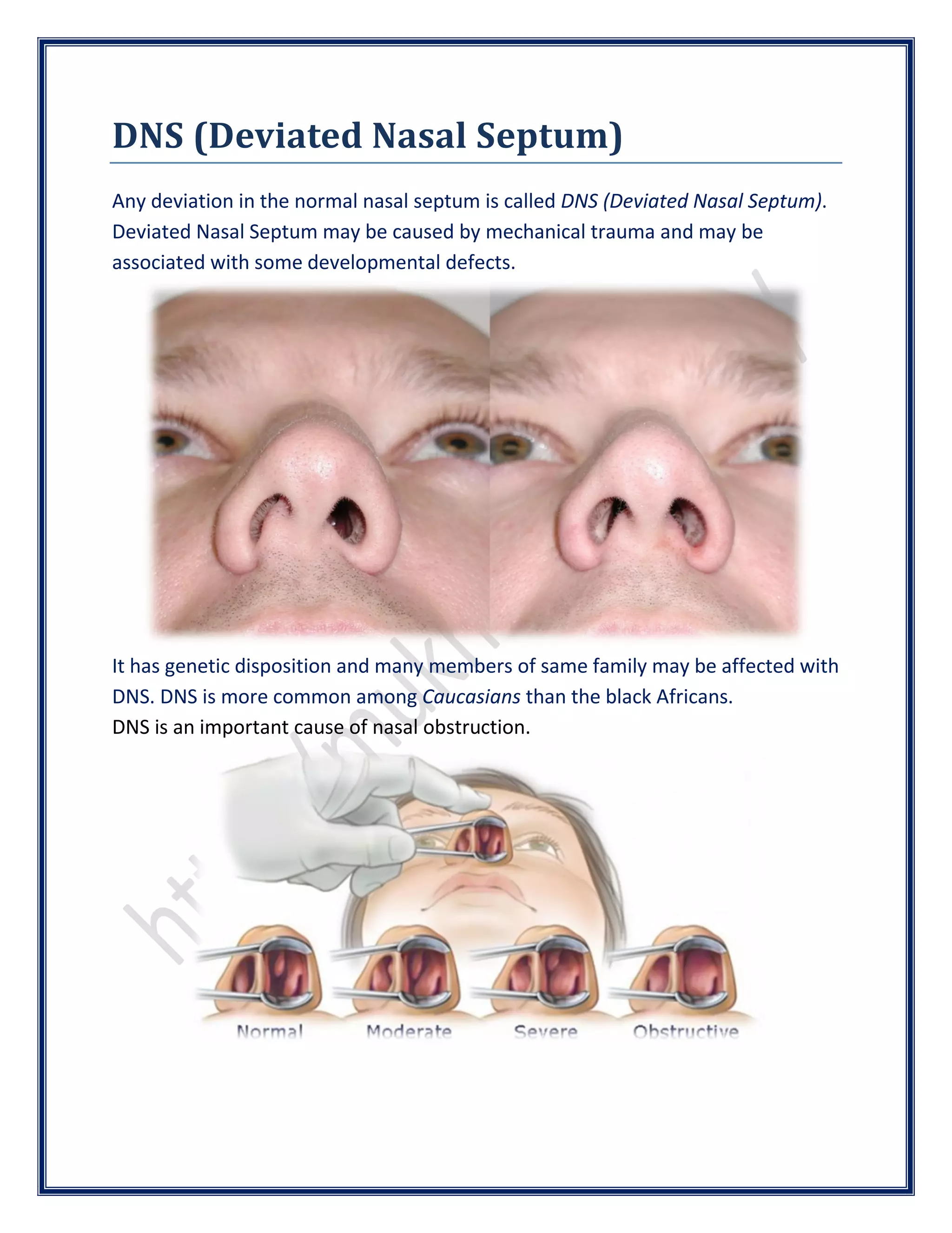 Dns (Deviated Nasal Septum) | SurgicoMed.com