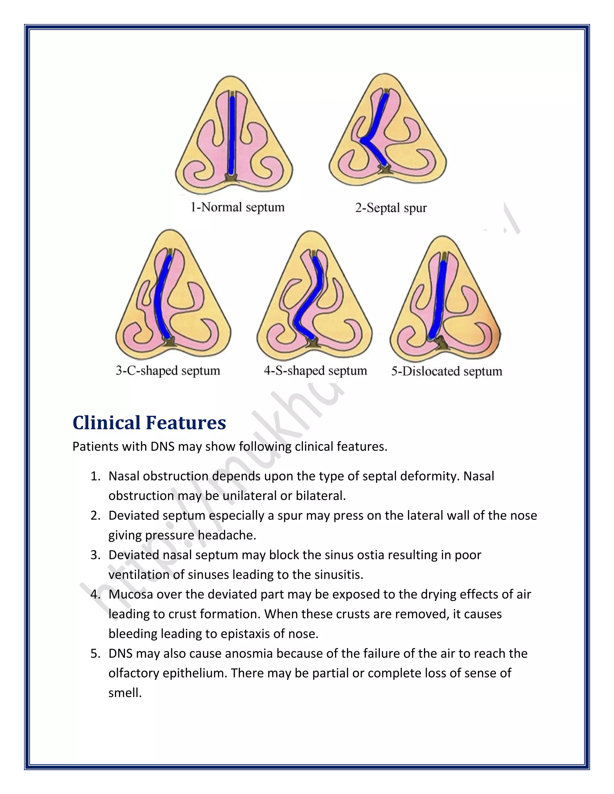 Dns (Deviated Nasal Septum) | SurgicoMed.com