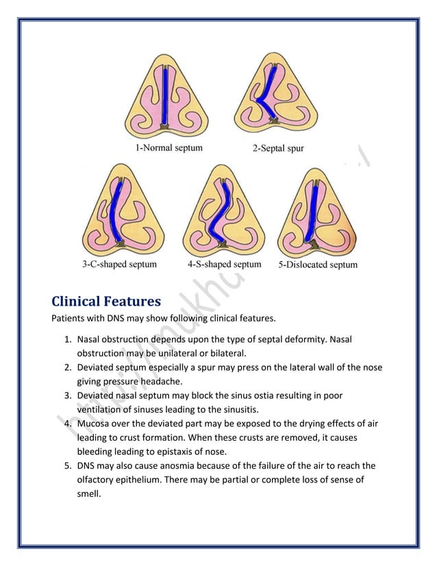 Dns (Deviated Nasal Septum) | SurgicoMed.com