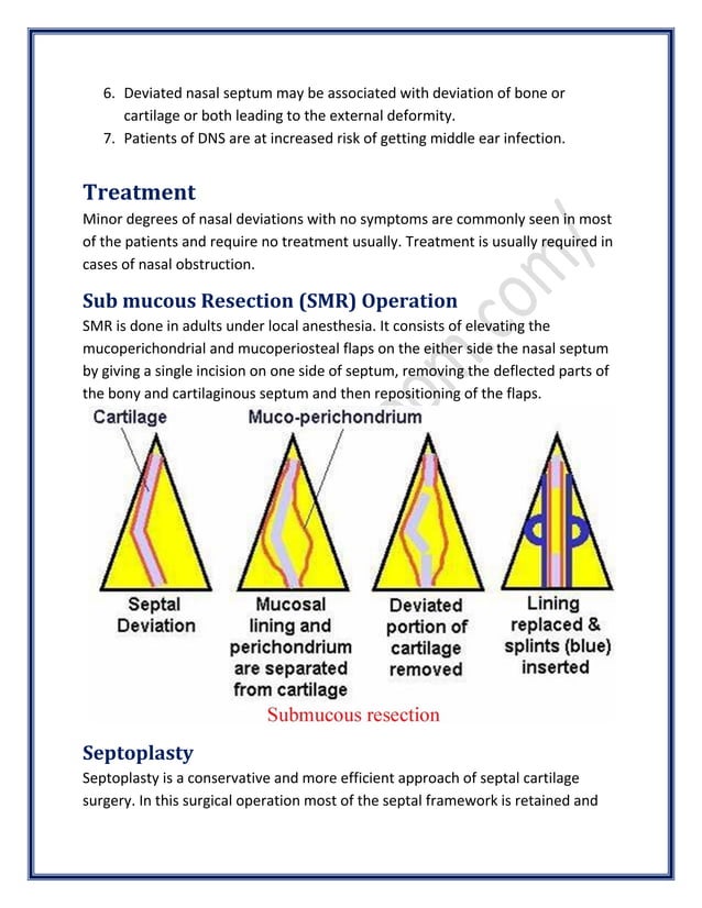 Dns (Deviated Nasal Septum) | SurgicoMed.com